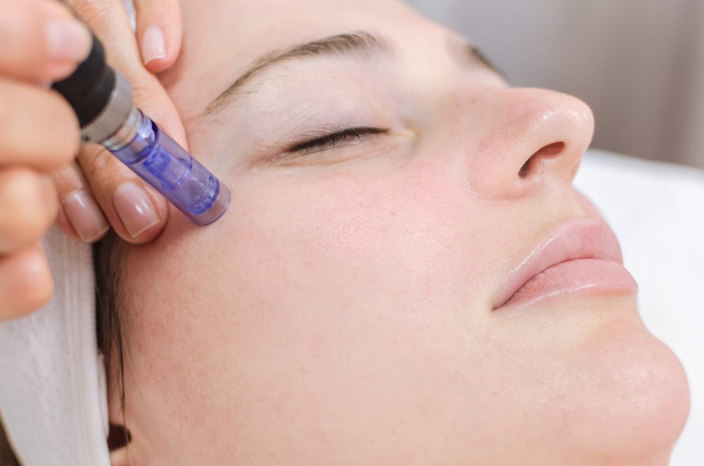 Who is suitable for micro needling? – Dr. Pen Store